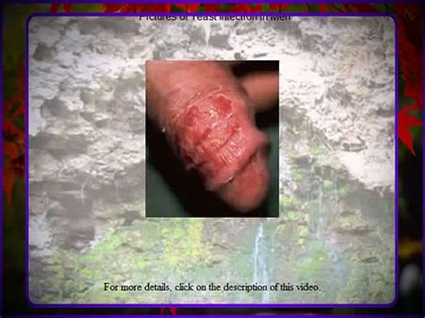 Male Yeast Infection