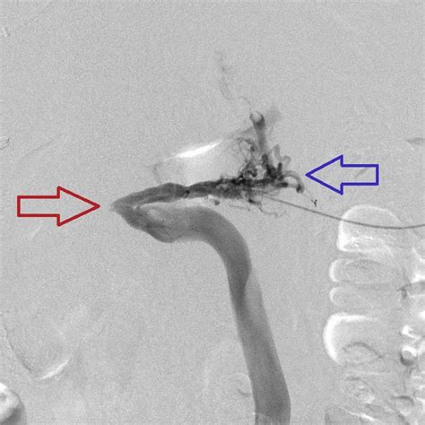 E A Splenic Venogram Demonstrating Tortuous Collateral Veins Blue