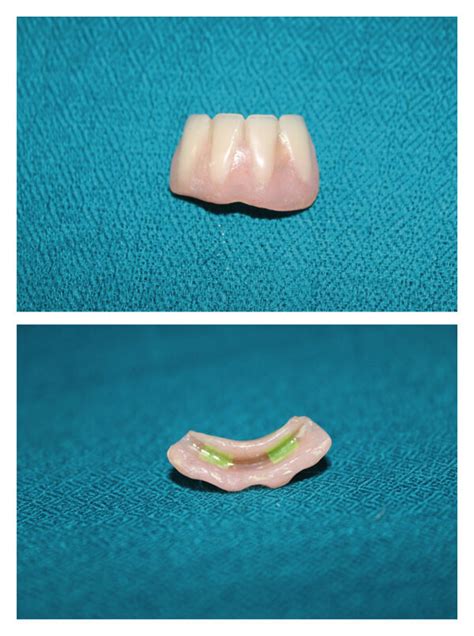 Andrews Removable Component With Ceka Preciline Attachments