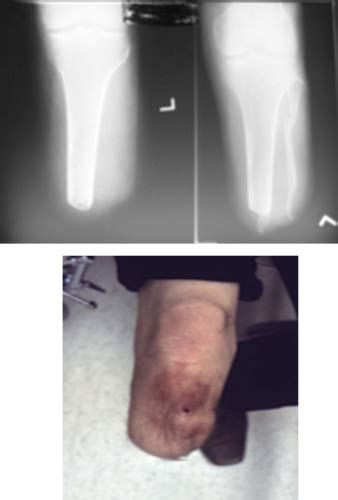 Trans Tibial Prosthetics Flashcards Quizlet