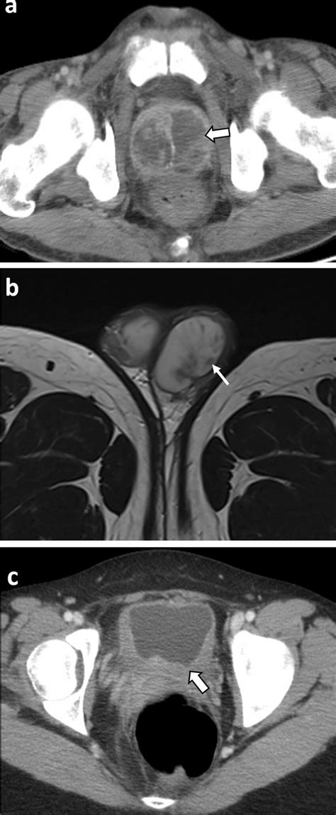 Genitourinary Tuberculosis In Different Patients A Tuberculosis Of The Download Scientific