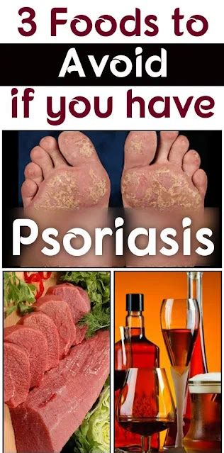 3 Foods To Avoid If You Have Psoriasis Healthy Lifestyle