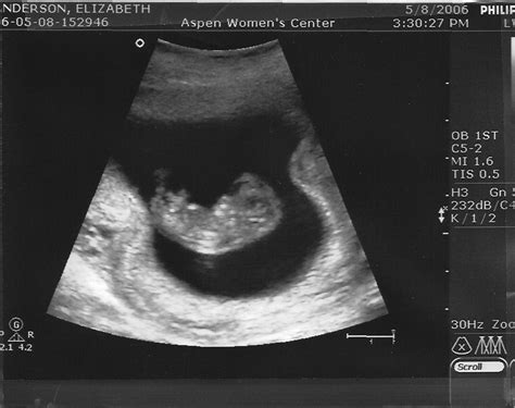 10 Week Ultrasound Pictures Maria Roberts