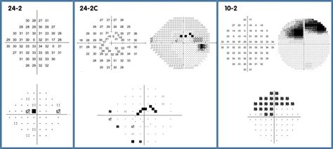 24 2c Visual Field Testing Glaucoma Managements Paradigm Shift Mivision