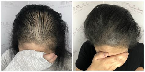 Scalp Micropigmentation For Women Full Micropigmentation