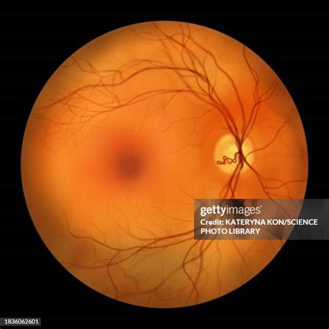 Prepapillary Vascular Loop On The Retina Illustration High Res Vector Graphic Getty Images Prepapillary Vascular Loop On The Retina Illustration High Res Vector Graphic Getty Images