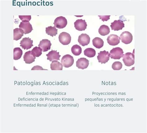 Yo Galeno Tipos De Eritrocitos En Frotis De Sangre