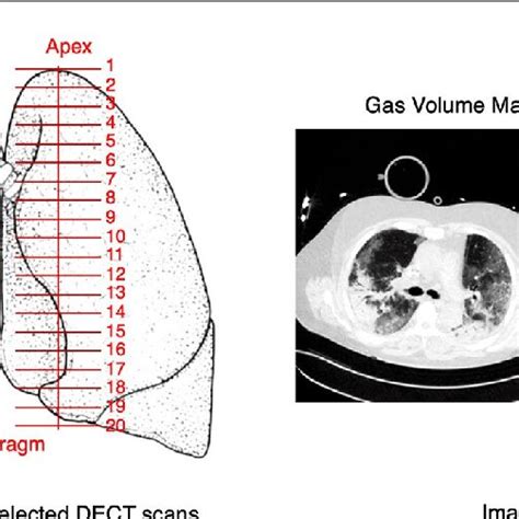Representative Example Of Dect Scans Collected On The No Steroids Group Download Scientific