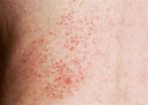 Heat Rash How To Treat It Quickly In Singapores Climate