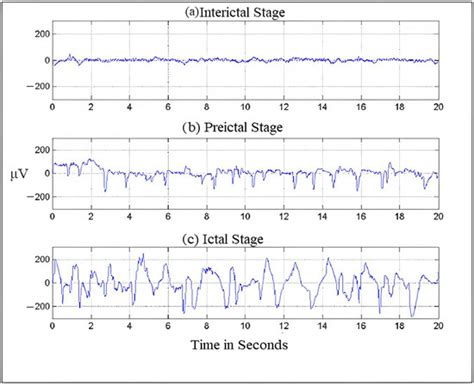 Electroencephalography Eeg Data Showing Onset Of An Epileptic Seizure