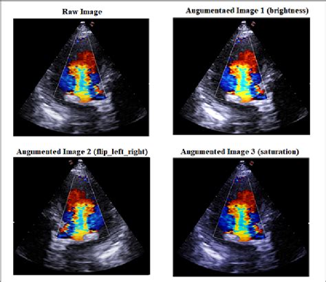 Echocardiogram View Classification By Deep Learning Model Download