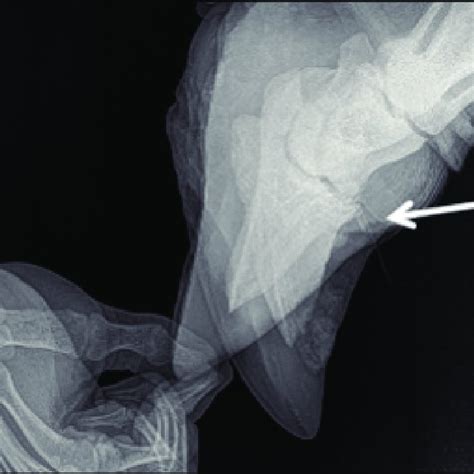 Radiographic Lesions Of Proliferative Bone Reaction In The Region Of Download Scientific