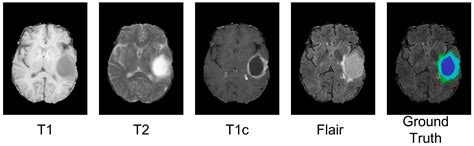 Axial Attention Convolutional Neural Network For Brain Tumor Segmentation With Multi Modality