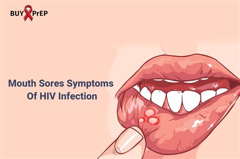 Mouth Sores Symptoms Of Hiv Infection Buy Prep