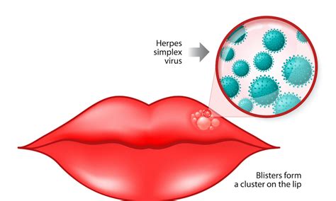 Cold Sore Inside Nose