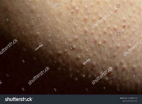 Keratosis Pilaris Illustration