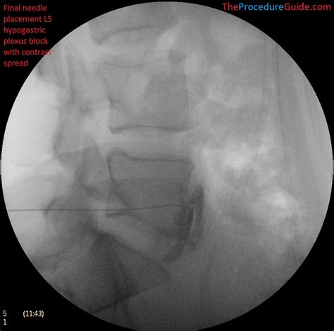 Hypogastric Plexus Block Technique And Overview The Procedure Guide