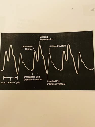 Iabp Flashcards Quizlet
