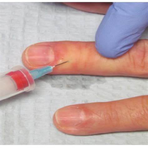 Mucous Cyst At Left Long Finger Download Scientific Diagram