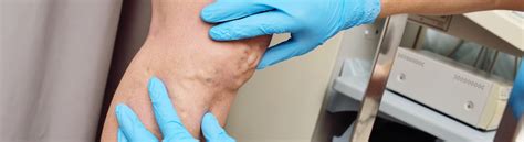 Phlébite Définition Symptômes Traitement Prévention Pharmacie