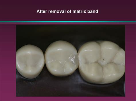 Ppt Class I And Ii Composite Restorations Principles And Techniques Powerpoint Presentation Id