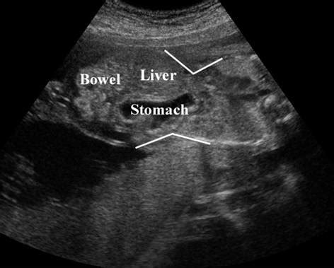 Ultrasound In Omphalocele