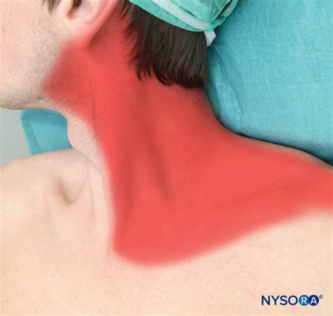 Ultrasound Guided Cervical Plexus Nerve Block Nysora