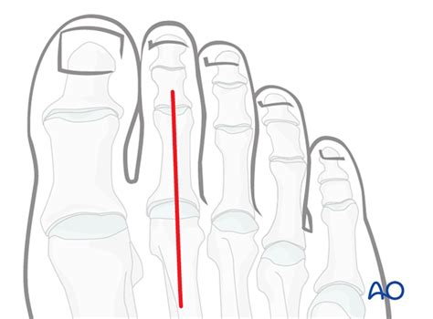 Great Mcp Joint Of Toe