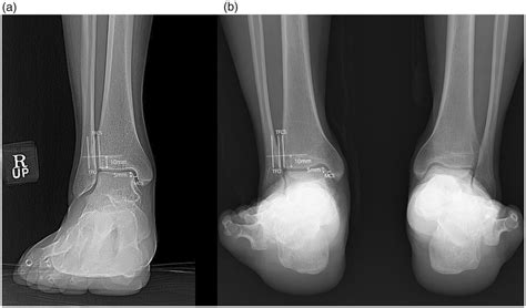 Measured Radiographic Parameters In The A Anteroposterior View And Download Scientific