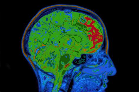 Understanding Frontotemporal Dementia