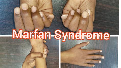 Arachnodactyly Marfan