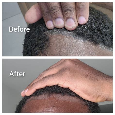 Rosemary Oil Miracle For Scalp Psoriasis R Psoriasis