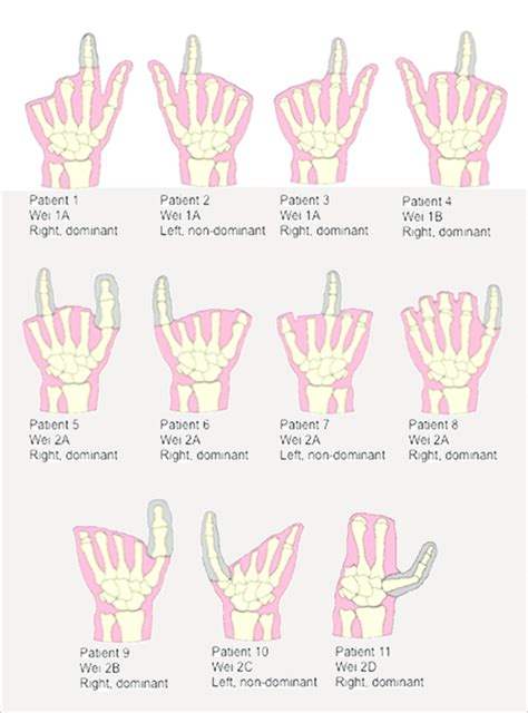 Schematic Representation Of Patients Who Underwent Reconstruction For Download Scientific