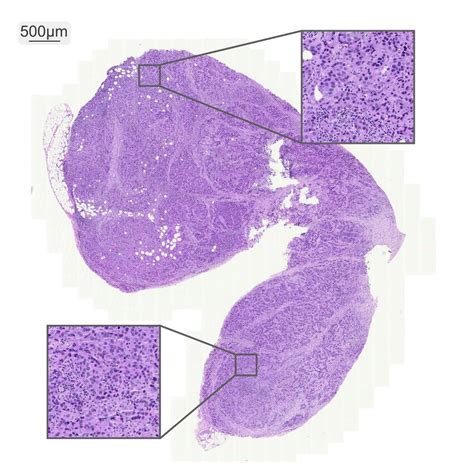 Attention Rollout Heatmap Of A Wsi Allows Us To Visualize The Download Scientific Diagram