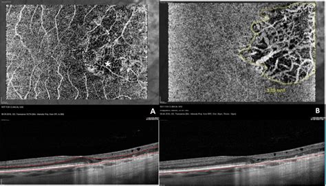 Choroidal Changes In SC Segmentation Of The Retina Showing A Defect