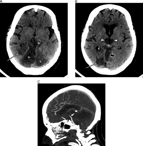 Coma During A Febrile Illness Respiratory Syncytial Virus Triggered