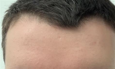 Can Minoxidil Regrow Miniaturized Hairs That Stopped Growing R Minoxidil