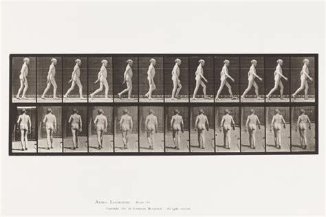Plate 562 Lateral Curvature Of Spine Walking 1885 Collotype On Paper Giclee Print