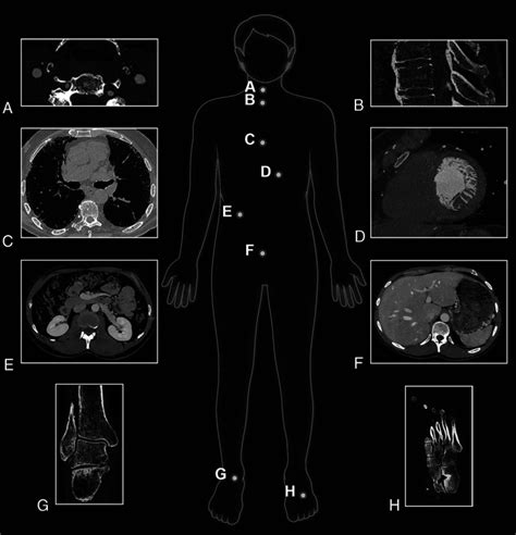 First Experience With A Whole Body Spectral Photon Counting Ct Clinical Prototype Pmc