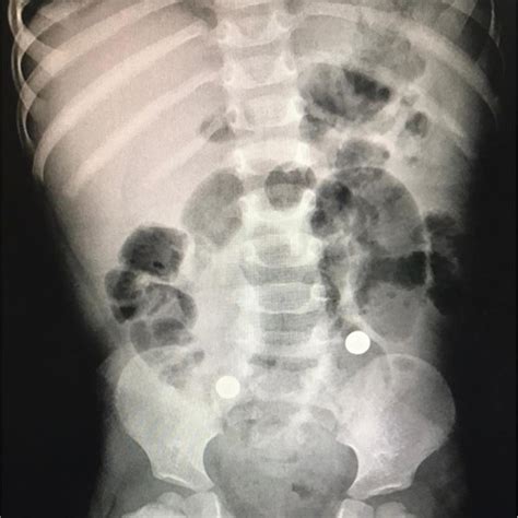 Negative Appendectomy Rate Nar 25 And Appendicitis Grade Aast Of Download Scientific