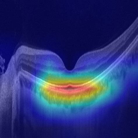 Octdl Optical Coherence Tomography Dataset For Image Based Deep
