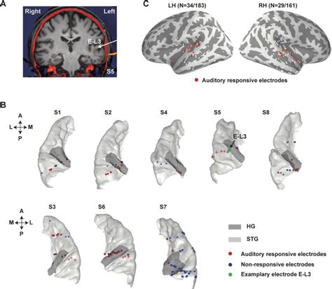 Electrode Localization And Anatomy Of The Auditory Cortex A Download Scientific Diagram