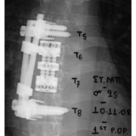 Compression Fracture T5 And T7 And Burst Fracture T6 Download Scientific Diagram