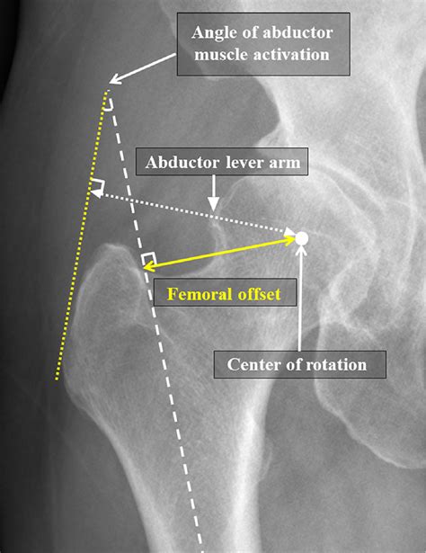 Figure 1 From Comparison Of Femoral Offset Measurement Accuracy Between Three Dimensional Ct And