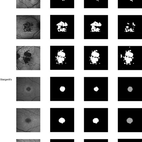 Overview Of The Entire Atrophy Segmentation And Prediction System Using Download Scientific