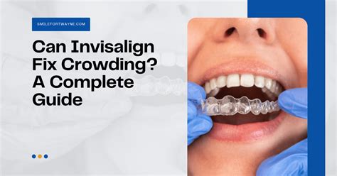 Can Invisalign Fix Crowding A Complete Guide