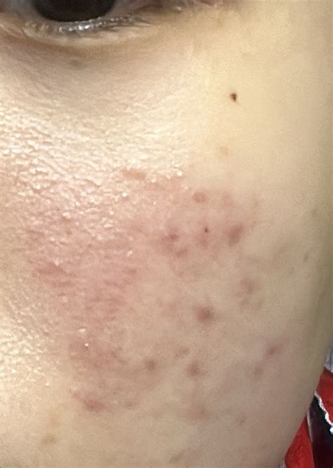 피부 붉은자국 여드름흉터 어떻게하나요 지식in