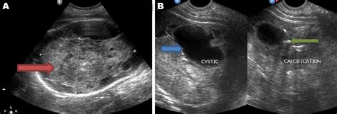 A Rare Case Of Large Fetal Intracranial Tumor Teratoma
