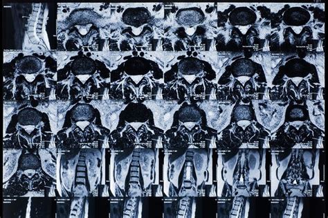 real mri scan of human spine