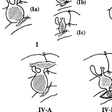 The Todani Classification Of Congenital Biliary Dilatation Download
